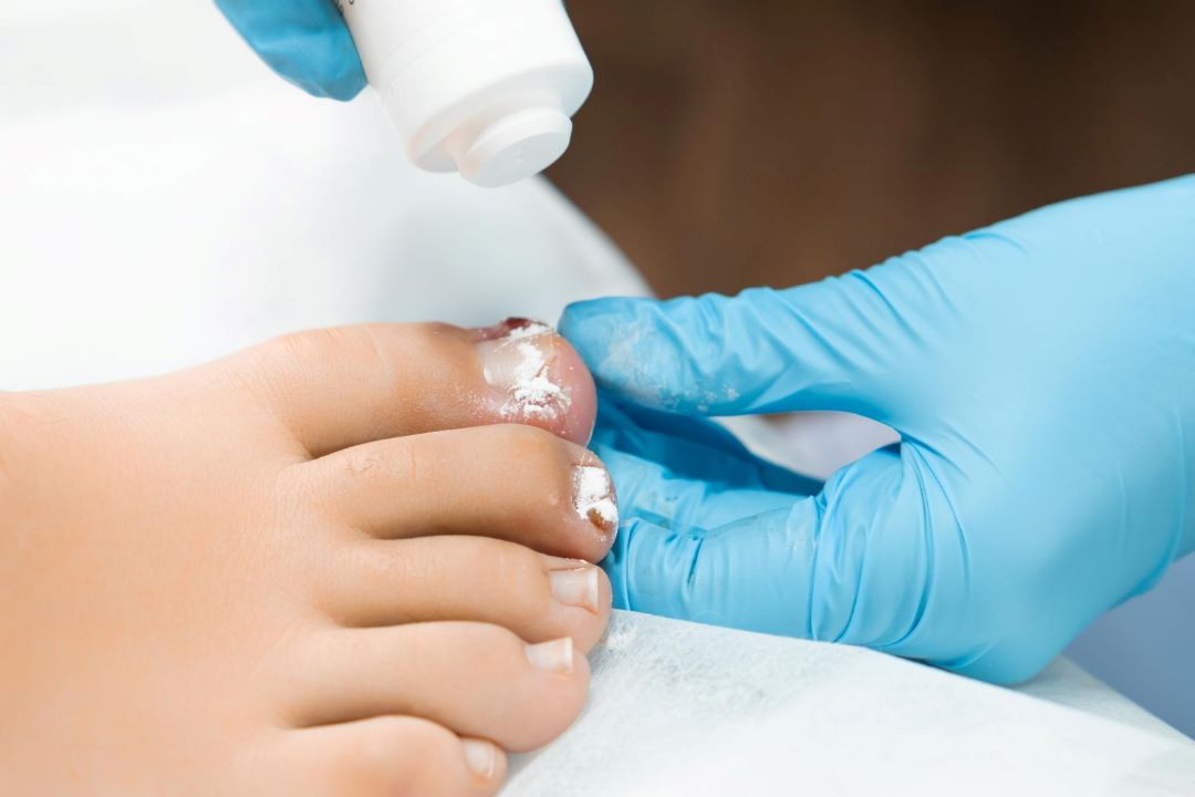 Ingrown & Fungal Toenail Treatment in NYC | Foot Specialist