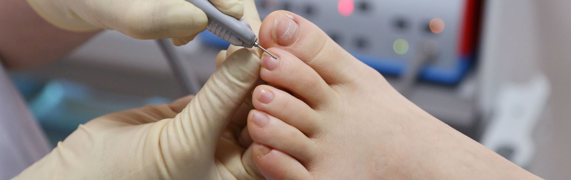 Ingrown & Fungal Toenail Treatment in NYC | Foot Specialist
