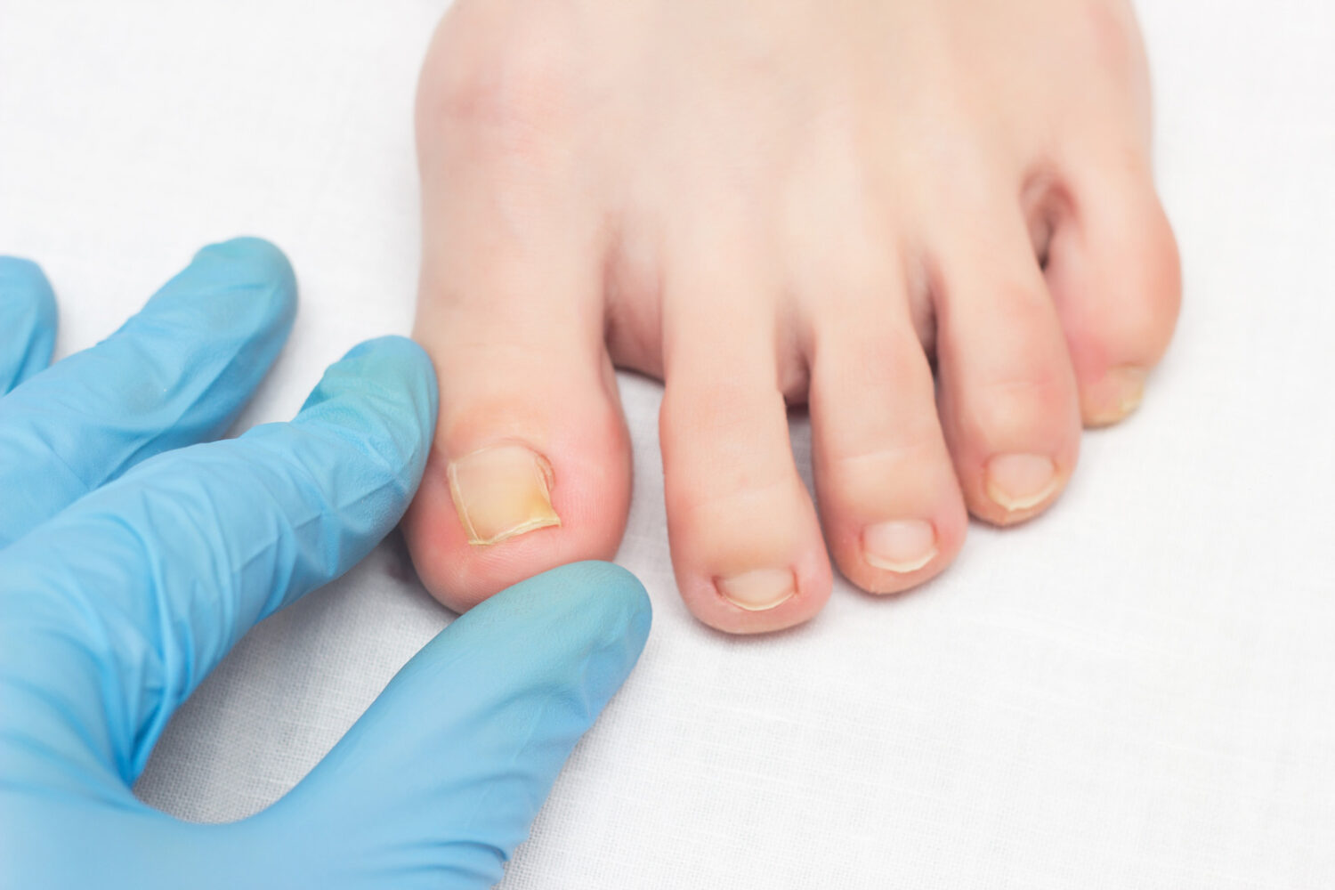 Ingrown & Fungal Toenails: Causes, Treatment & Prevention